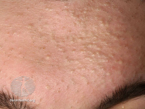 Global Acne Grading System (GAGS) training module - K B Lim Skin Clinic ...